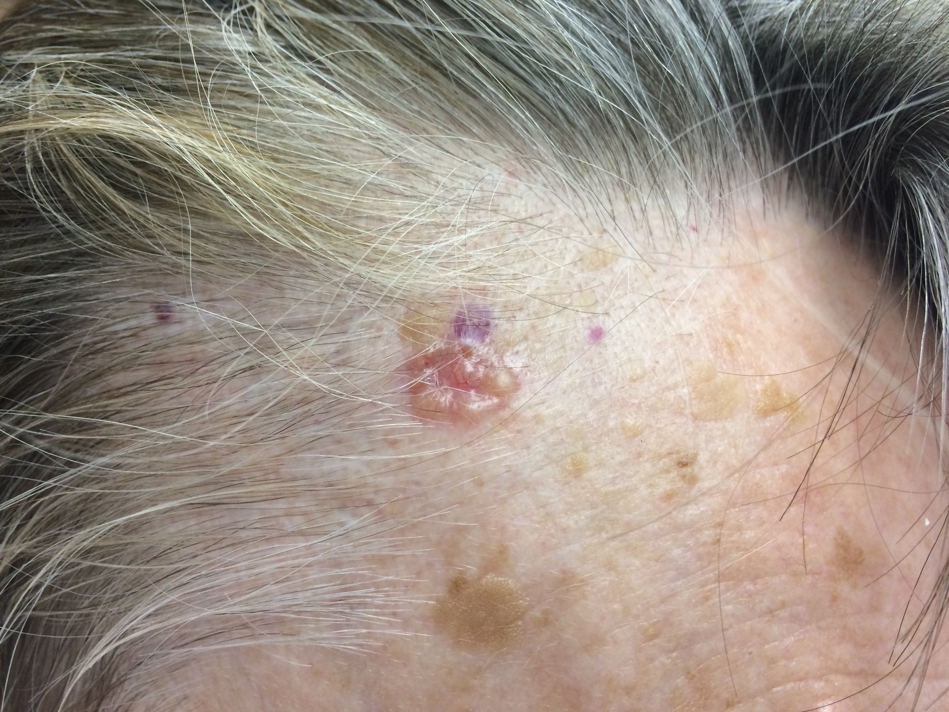 Basal Cell Carcinoma Dr N Raboobee Dermatologist Westville Basal Cell Carcinoma Dr N Raboobee Dermatologist Westville