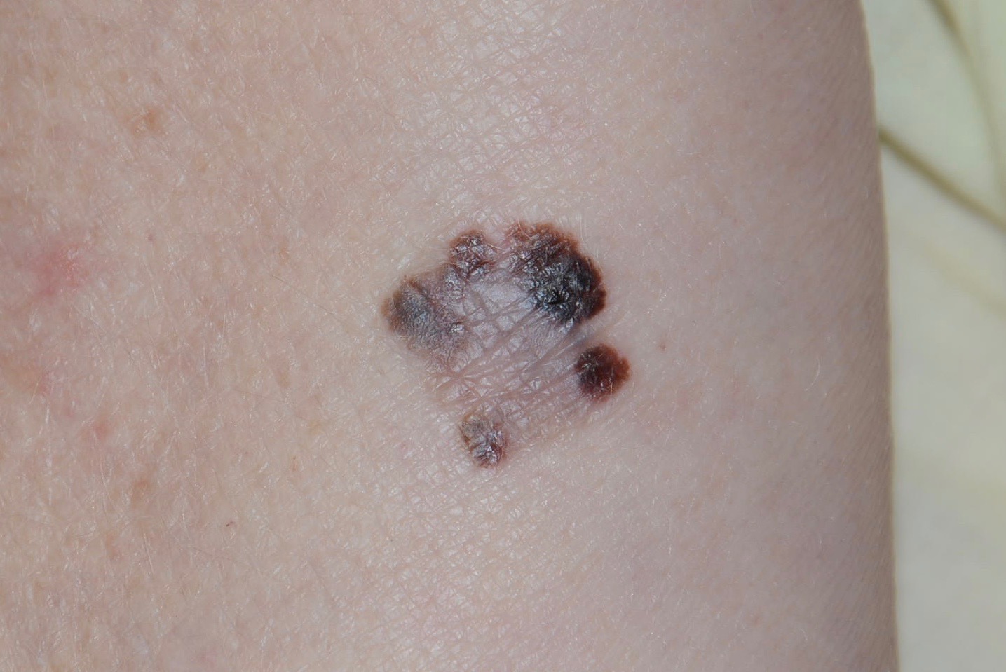 Melanoma | drnraboobee-1
