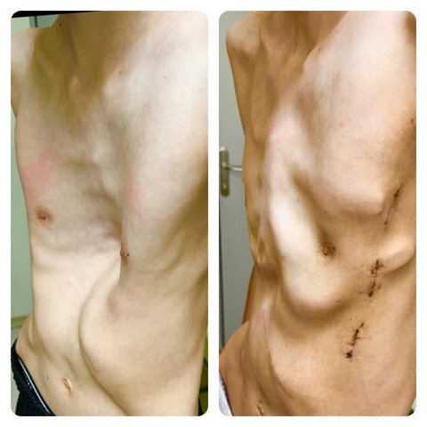 Pectus Excavatum Sugical and Non-Surgical Treatments in Turkey ...