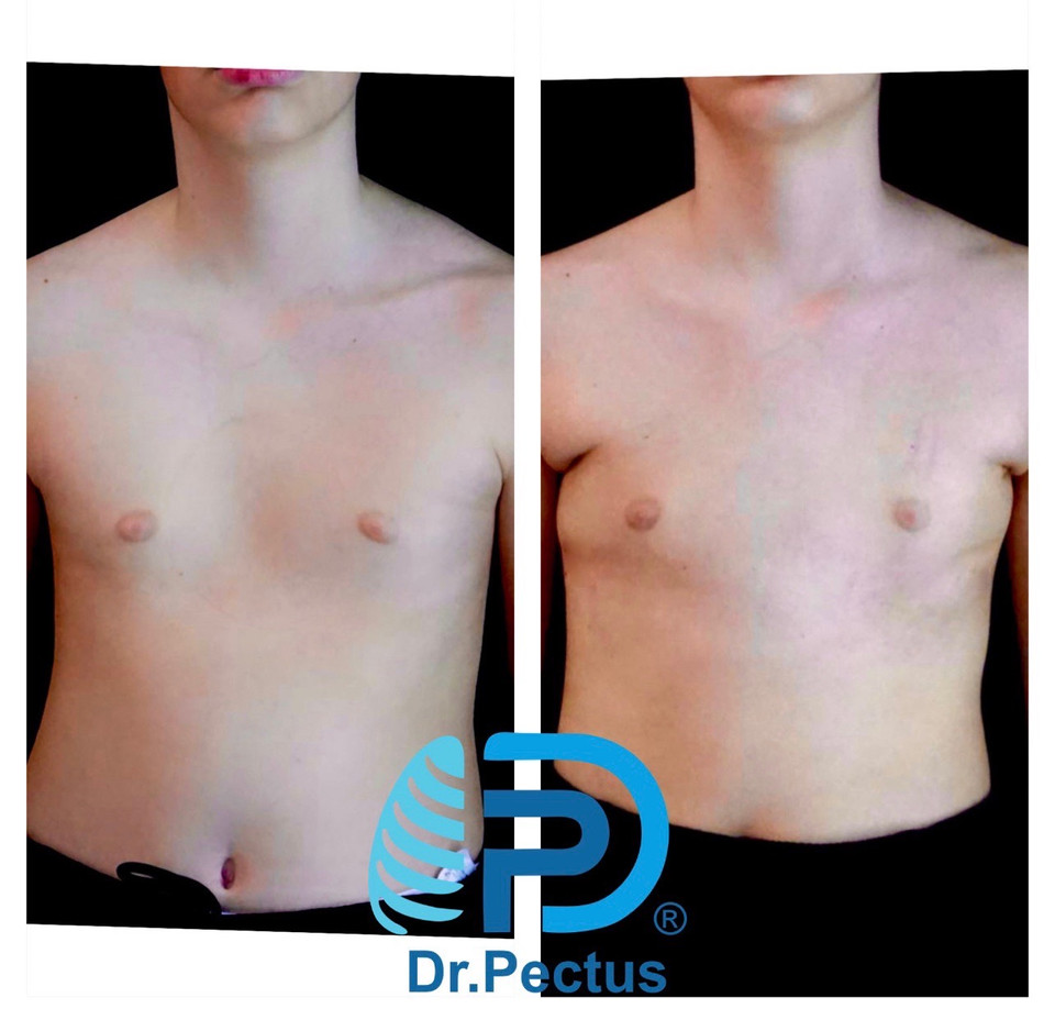 Pectus Excavatum Sugical and Non-Surgical Treatments in Turkey ...