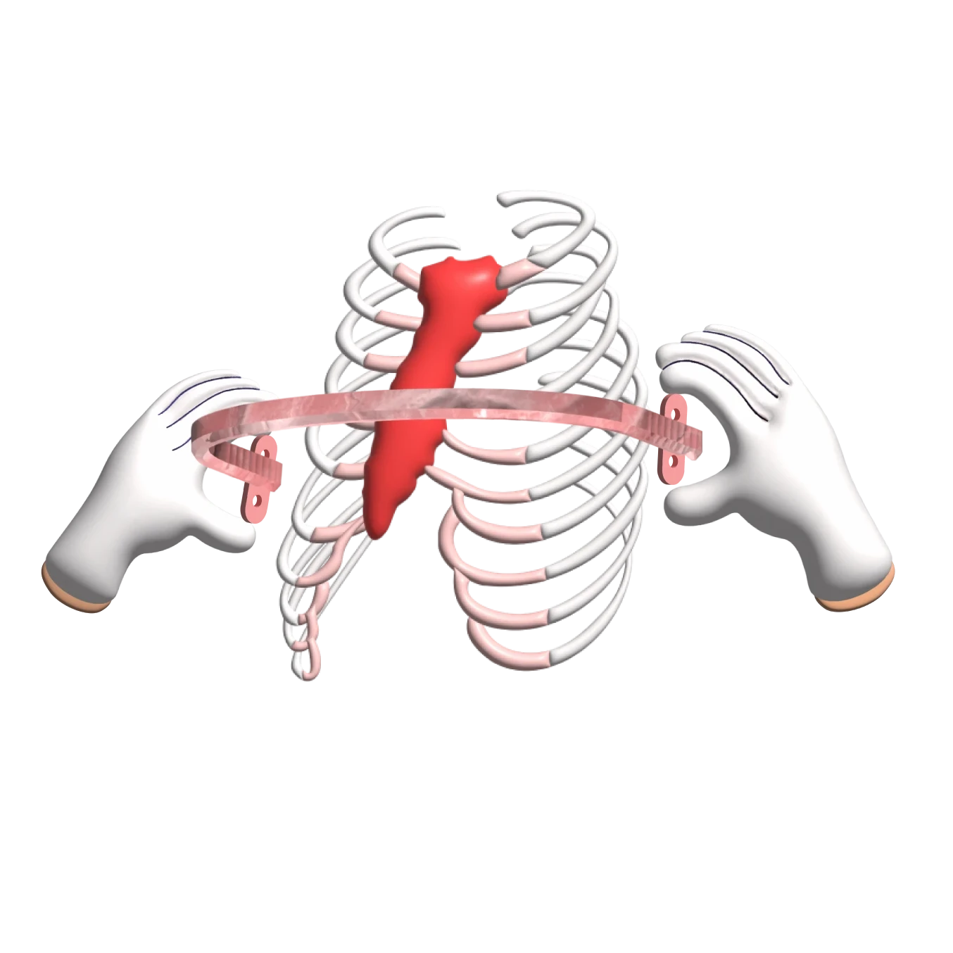Pectus Excavatum Sugical and Non-Surgical Treatments in Turkey ...