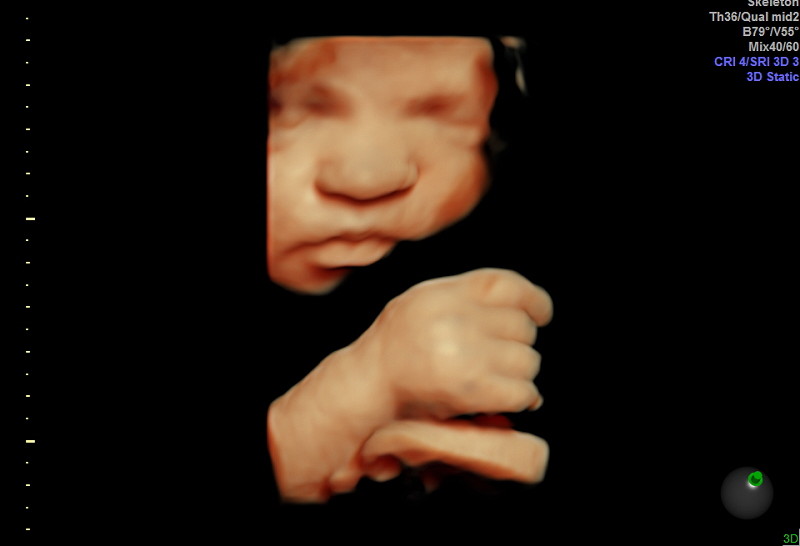 Hey Baby 4d Ultrasound Wexford, PA Gender Reveal