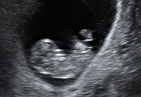 Hey Baby 4d Ultrasound Wexford, PA Gender Reveal
