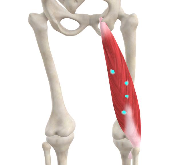 TRIGGER POINT OF THE WEEK – BICEPS FEMORIS