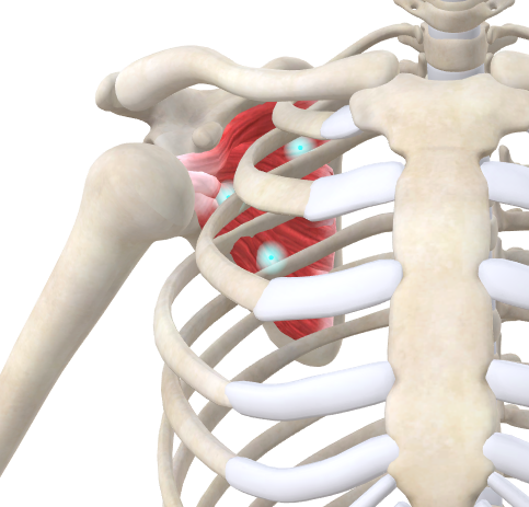 TRIGGER POINT OF THE WEEK – SUBSCAPULARIS