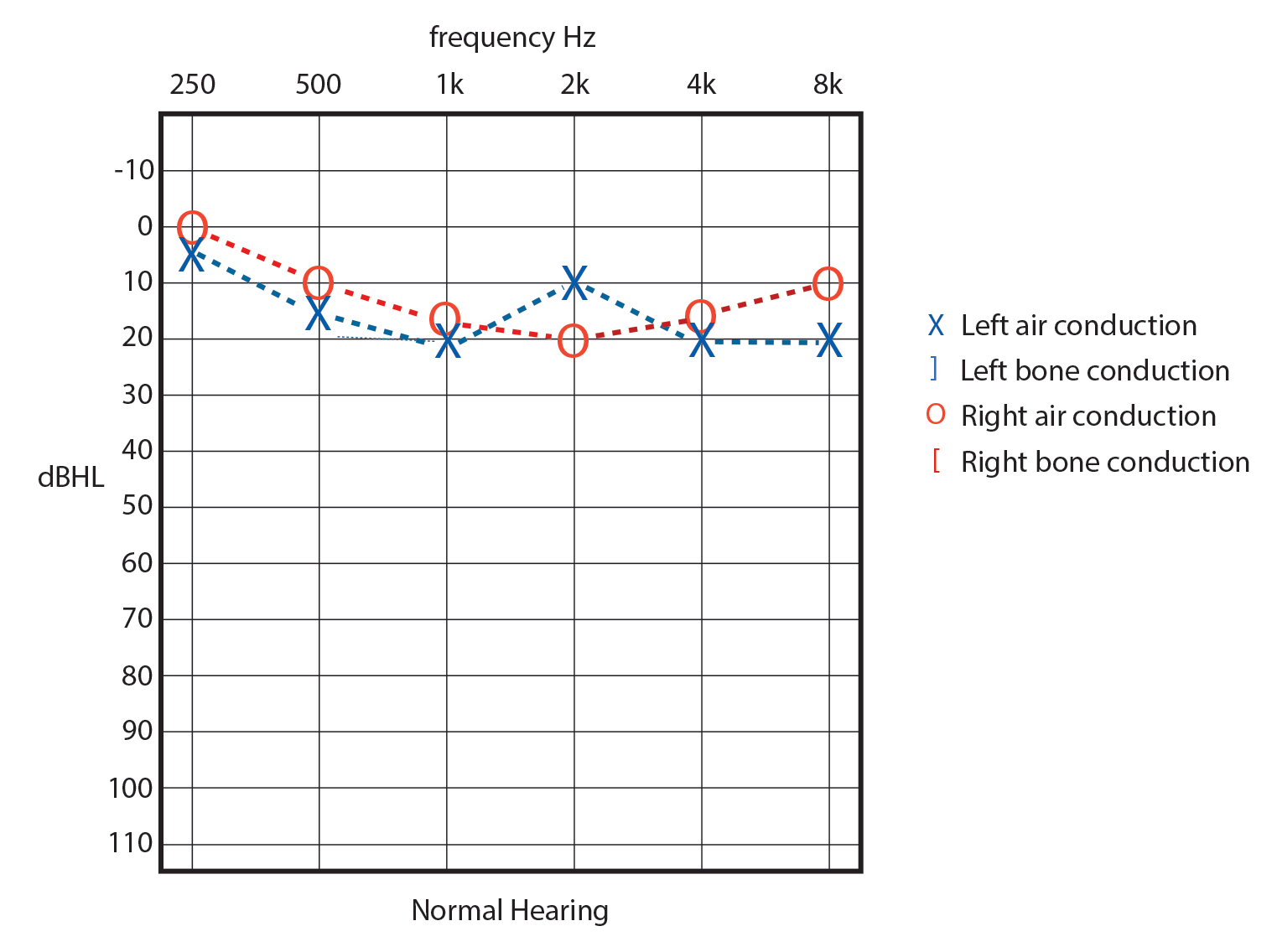 Normal Audiogram