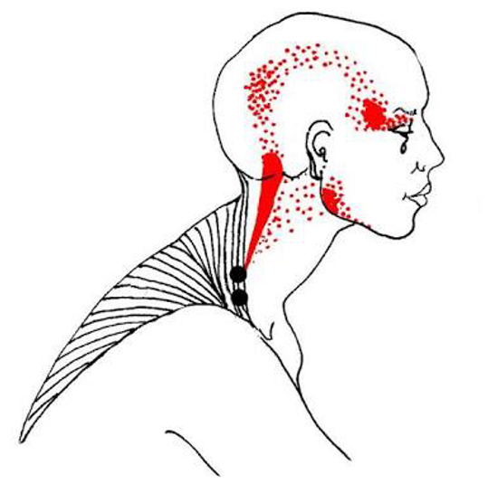 trigger point head and neck