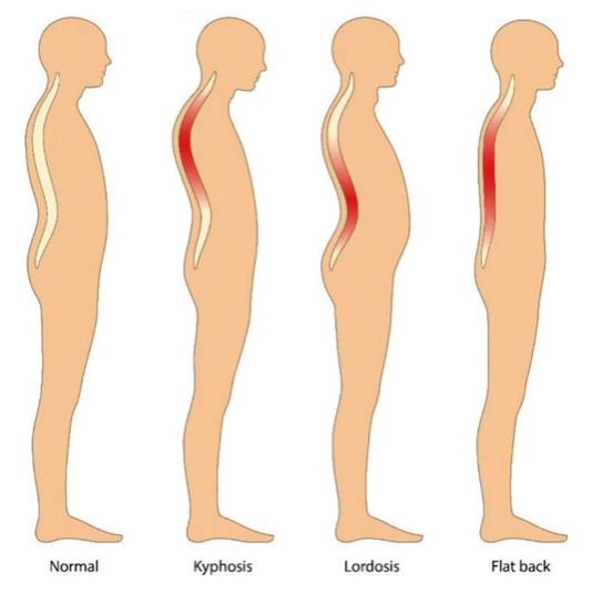 The Flat-Out Truth on Flatback Syndrome
