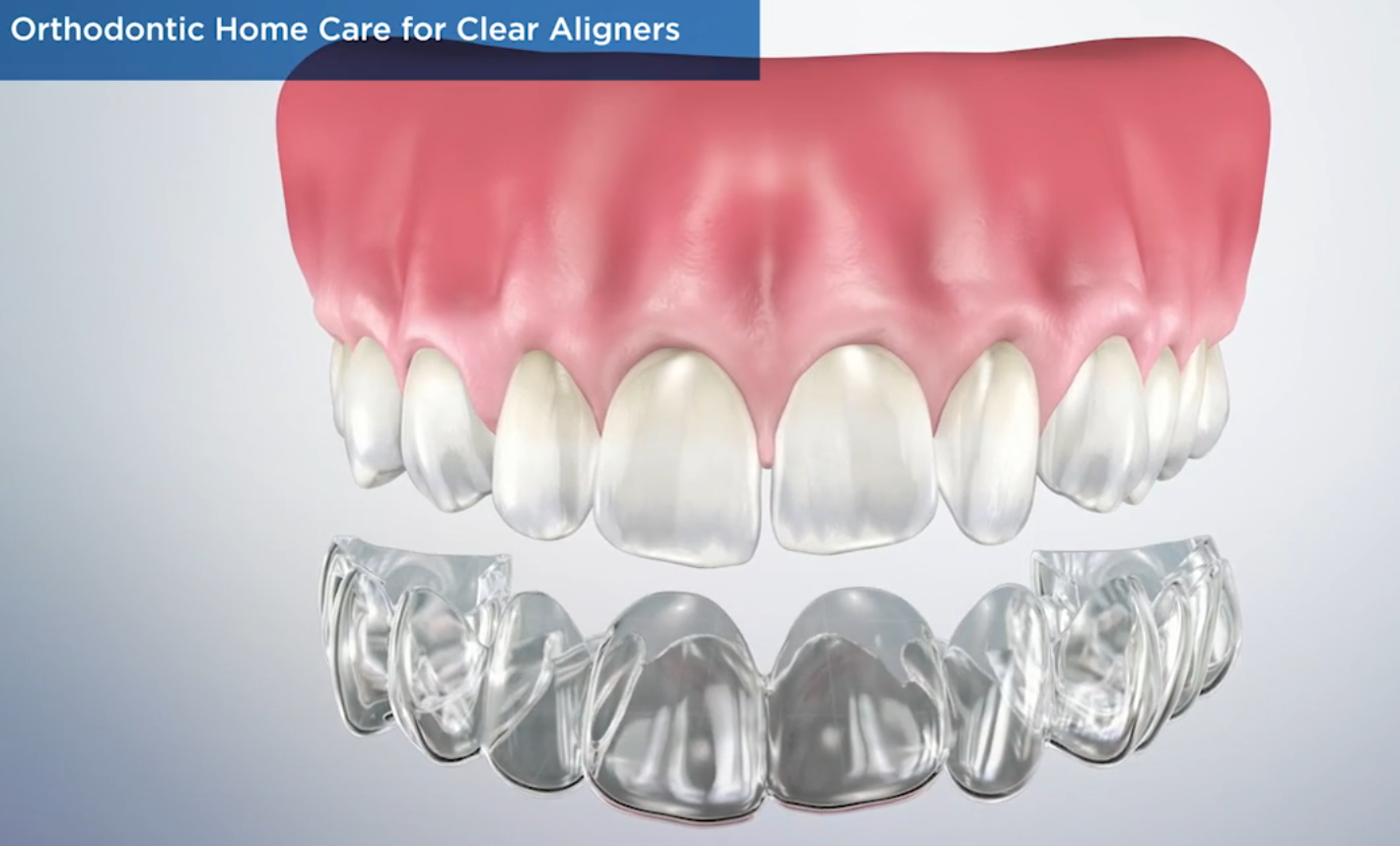Clear Aligner