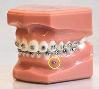 Temporary Anchorage Devices (TADs)