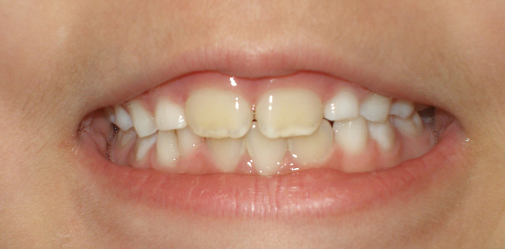 Why are my child’s new teeth yellow?