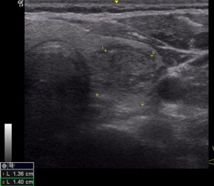 Understanding the ACR TIRADS System for Ultrasound of Thyroid Nodules