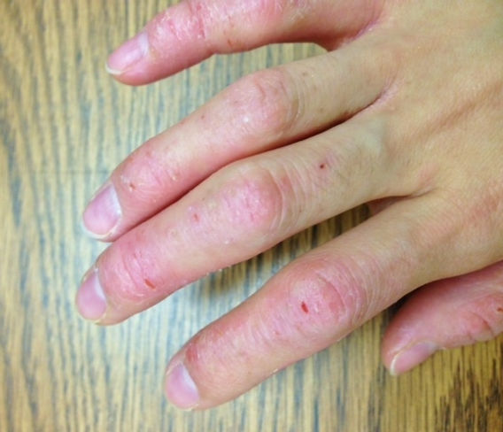 Atopic Dermatitis Hands