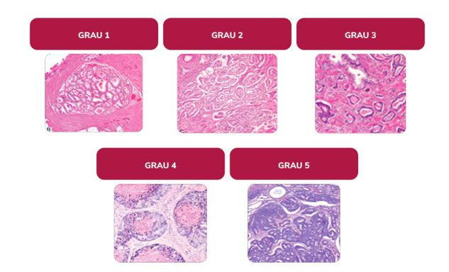 ISUP ?? Gleason ?? O que seria isso