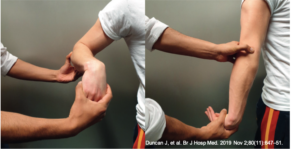 Epicondilite lateral do cotovelo ("tennis elbow") | Dr Fernando Brandão