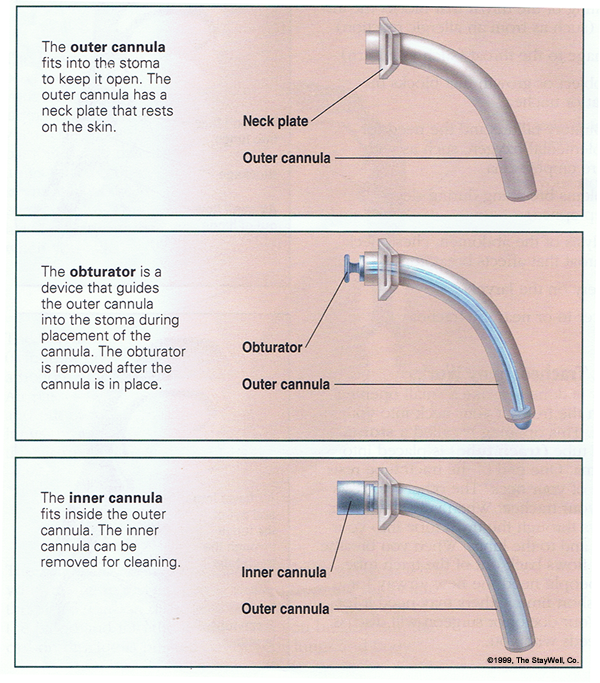 Tracheostomy (기관절개관 수술, 종류, 관리, seal off 까지 ~) : 네이버 블로그
