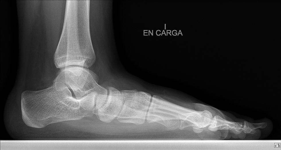 Técnica de Calcaneo Stop para manejo del pie plano