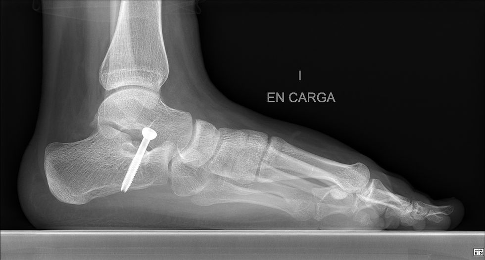 Técnica de Calcaneo Stop para manejo del pie plano