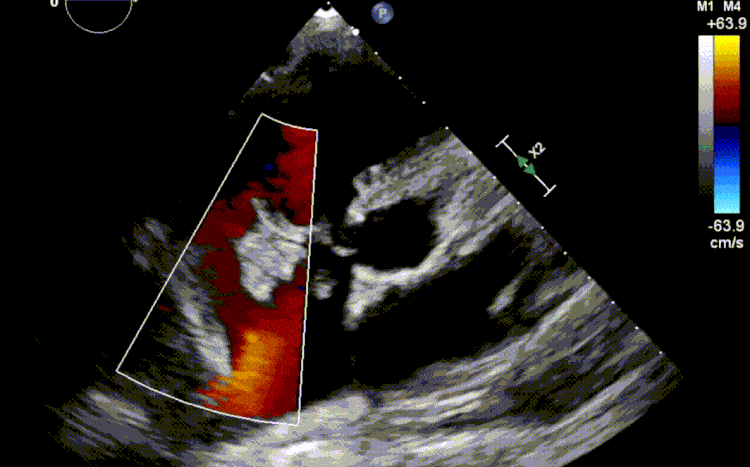 06. Right Ventricle Dysfunction | showmethepocus