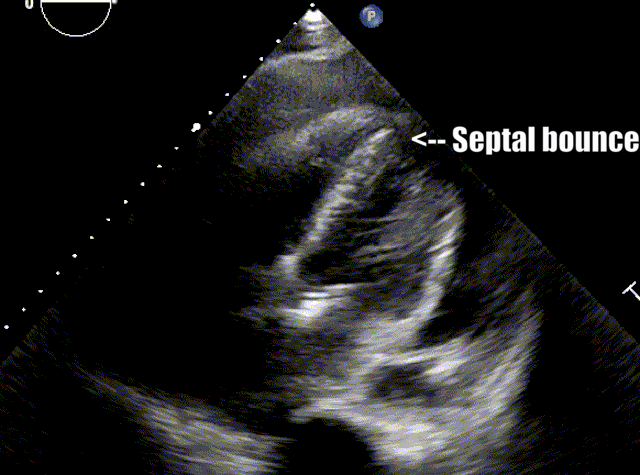 cardiac tamponade echo protocol