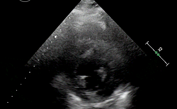 03. Left Ventricle Dysfunction | showmethepocus