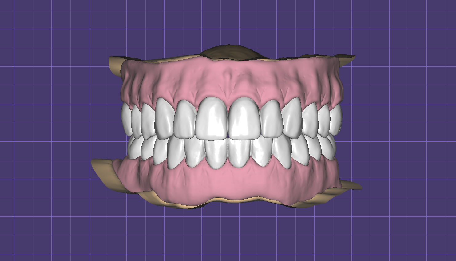 Digital Full Dentures with Patient Digital Twin & Exocad (16 CE) | FMR ...