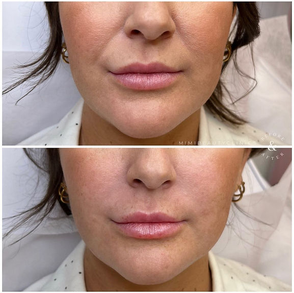 Nasolabial Fold (smile lines) | Koukla Aesthetics