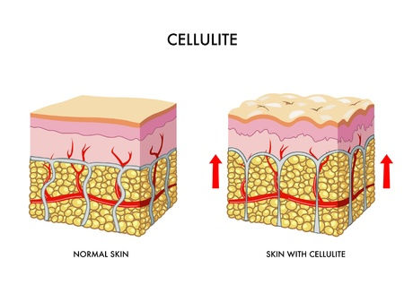 I 4 stadi della cellulite. Come riconoscerli e come contrastarli.