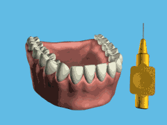 What is the purpose of interdental brushes and water pick in dentistry ...