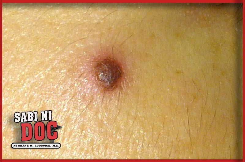 Paraan para malaman kung cancerous ang nunal