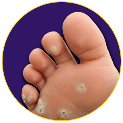 Verrucas: What They Are, How to Treat Them, and Why You Should See a ...