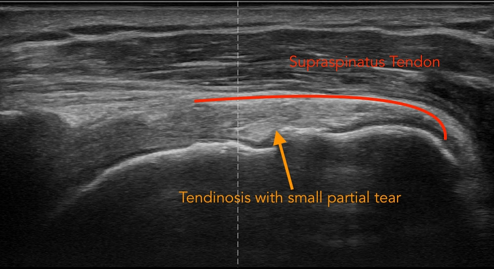 Rotator Cuff Regenerative Medicine: Cure Tendonitis and Partial Tears ...
