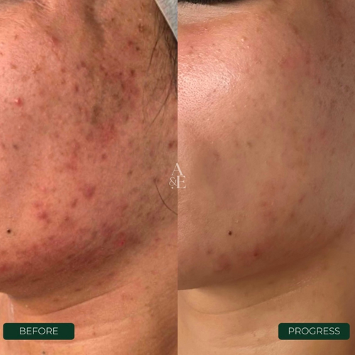 Modified Jessner Peel Treatment Experts in Sydney | Adam & Eve ...