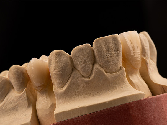 Blue Dental Lab | Bridging Smiles | Orthodontic Appliances