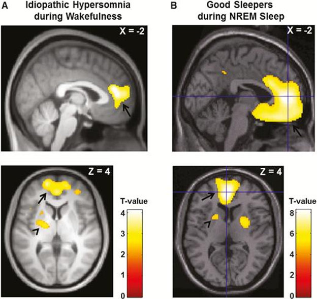 Study suggests possible trait unique to Idiopathic Hypersomnia