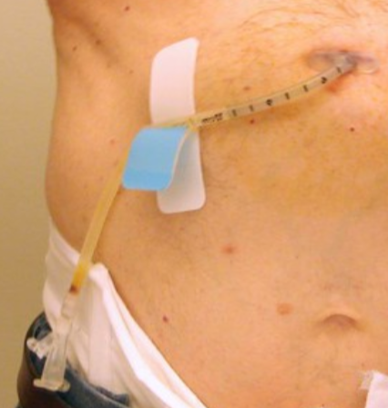 The Threes of G's - Troubleshooting the PEG Tube