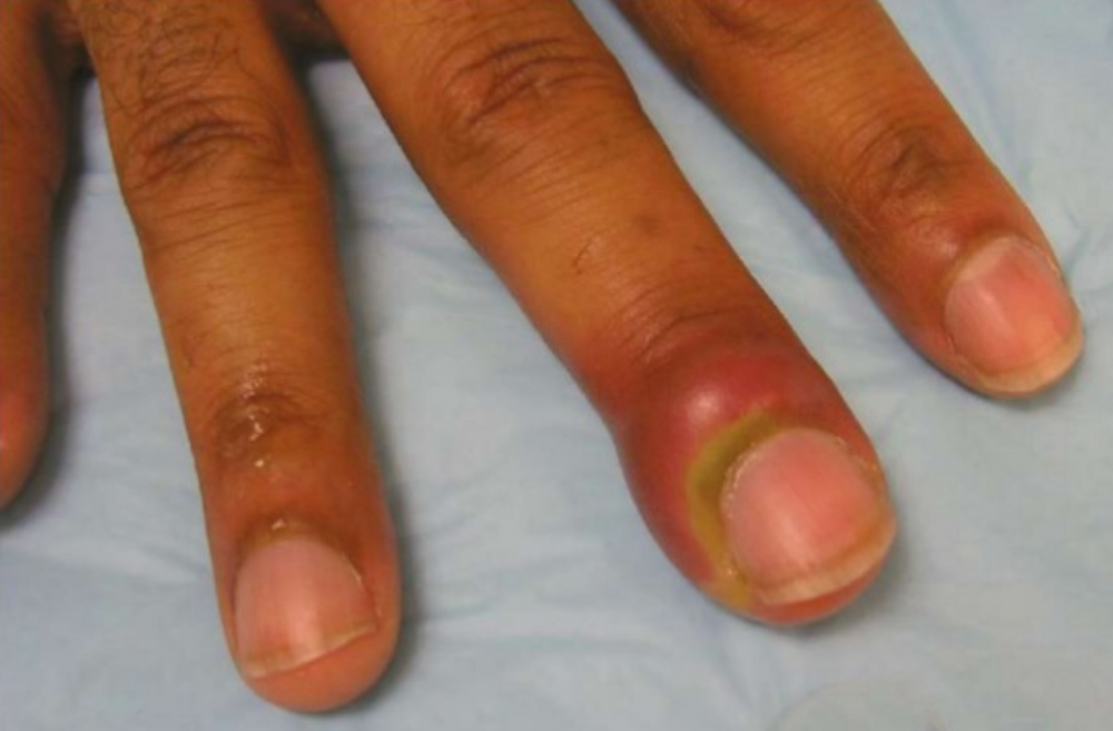 Stop Biting Your Nails Paronychia Drainage Stop Biting Your Nails Paronychia Drainage