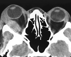 Ideopathic Orbital Inflammation | Jonathan Dutton Ocul