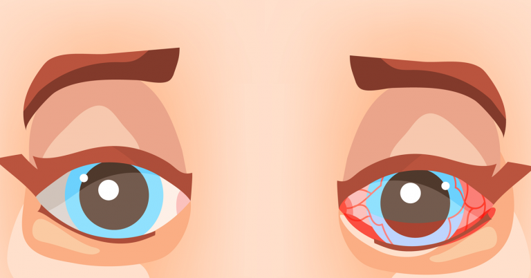 Olhos vermelhos: o que pode ser e quando devo me preocupar