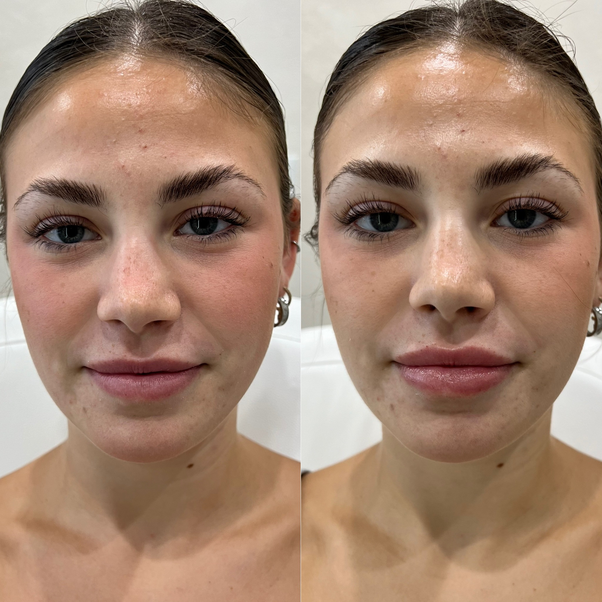 Mini Lip Filler
