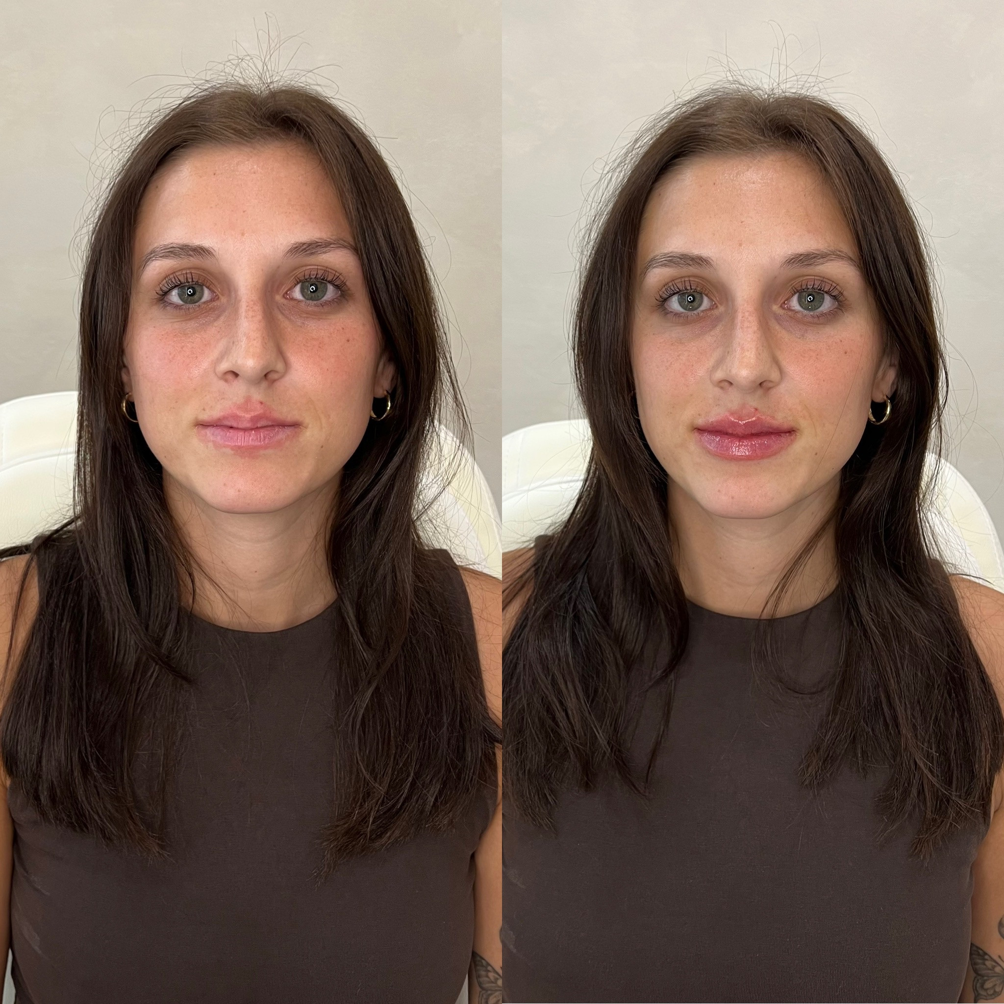 Mini Lip Filler