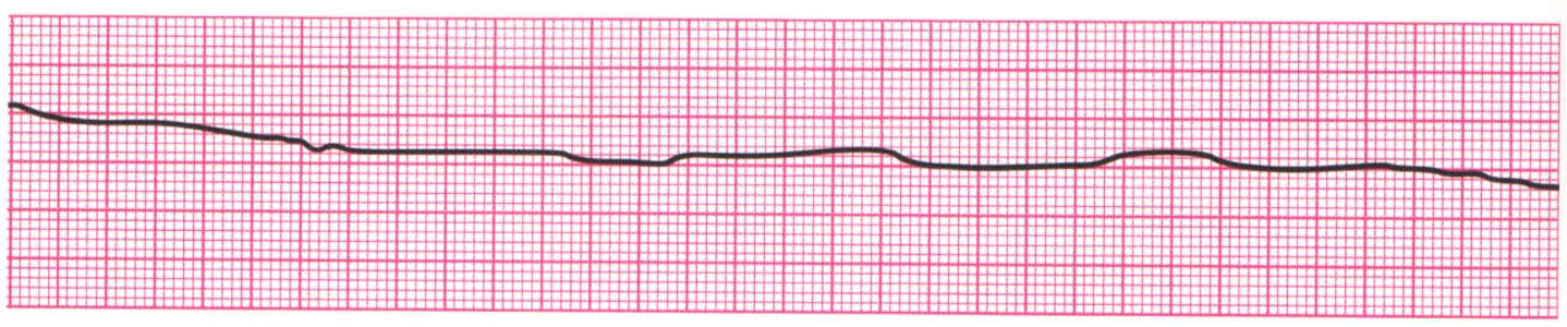 Asistole | CPTC Healthpoint