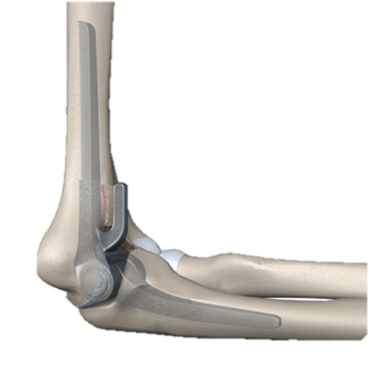 Reemplazo total de codo (Prótesis de codo) | Dr Salvador Arreola