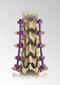 NuVasive® Precept™ Spinal System
