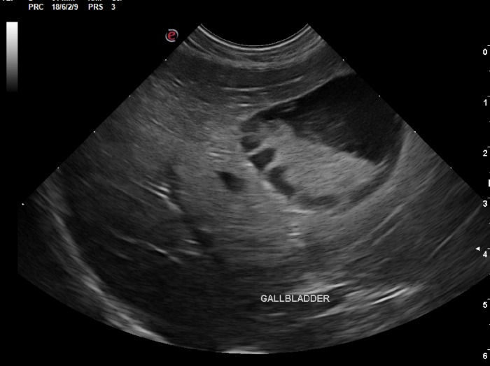 Gallbladder Mucocele