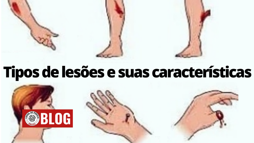Tipos de lesões e suas características