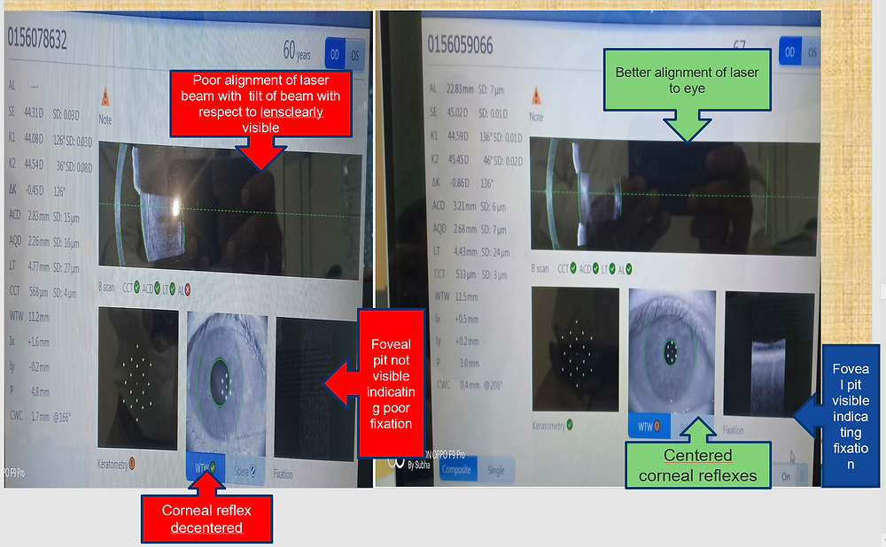 Patient Fixation with IOL Master 700 Biometry
