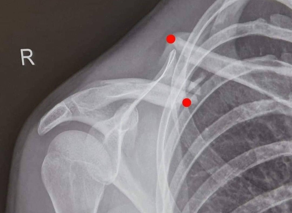 The Clavicle Chronicles Continues...