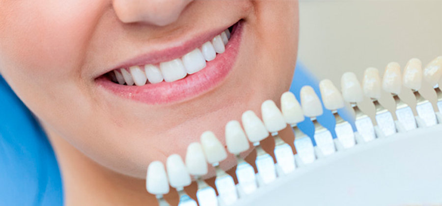 Mitos y verdades del Blanqueamiento dental Mitos y verdades del Blanqueamiento dental