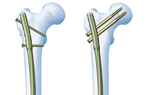 DePuy Synthes Femoral Recon Nail System